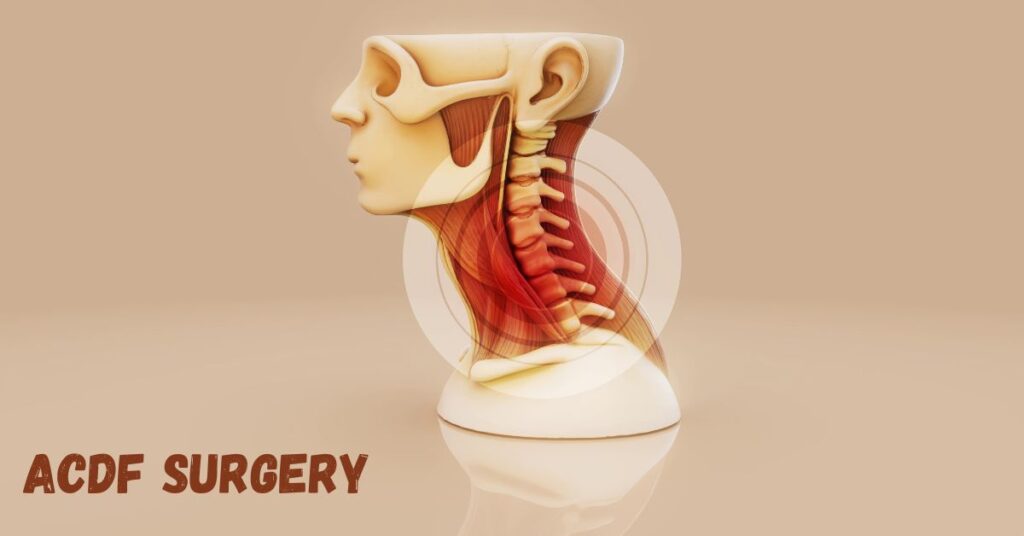 ACDF Surgery: A Comprehensive Medical Overview